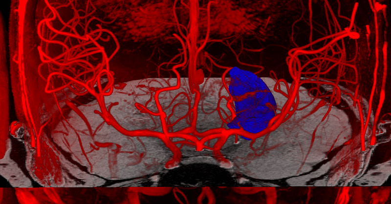 New study expands understanding of brain blood flow and neurological ...